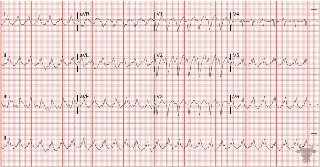 Ventricular Tachycardia | ECG Stampede