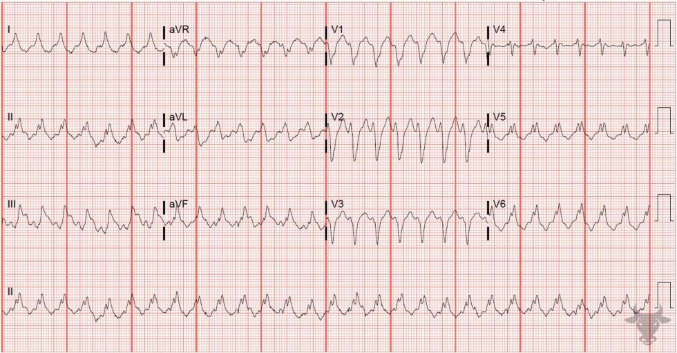 Ventricular Tachycardia | ECG Stampede
