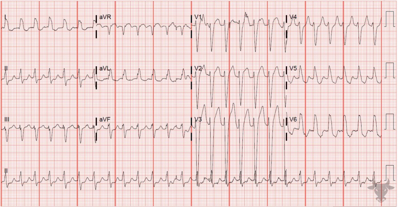 Supraventricular Tachycardia with Aberrancy | ECG Stampede