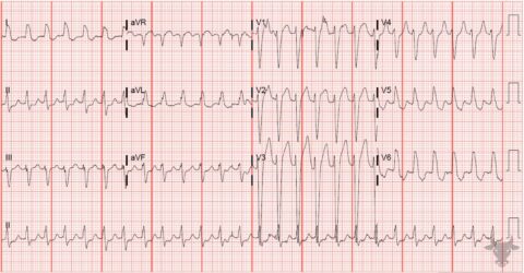 Supraventricular Tachycardia with Aberrancy | ECG Stampede