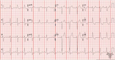 Left Bundle Branch Block | ECG Stampede