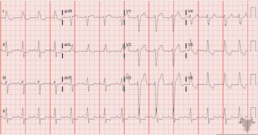 Left Bundle Branch Block | ECG Stampede