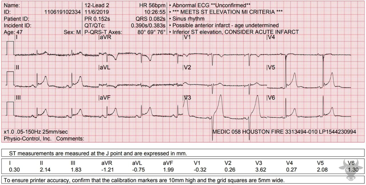 ST-elevation Myocardial Infarction | ECG Stampede