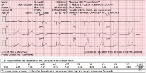 ST-elevation Myocardial Infarction | ECG Stampede
