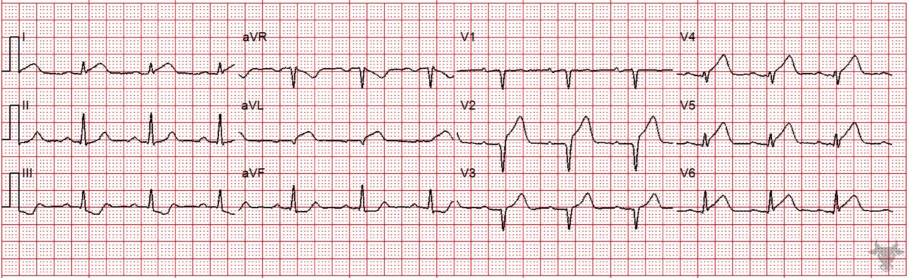 ST-elevation Myocardial Infarction | ECG Stampede
