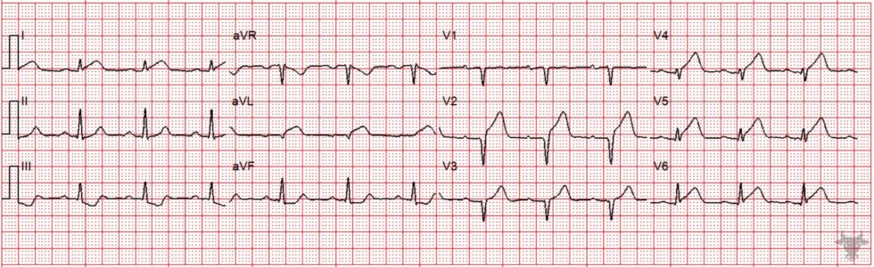 Hyperacute T Waves | ECG Stampede