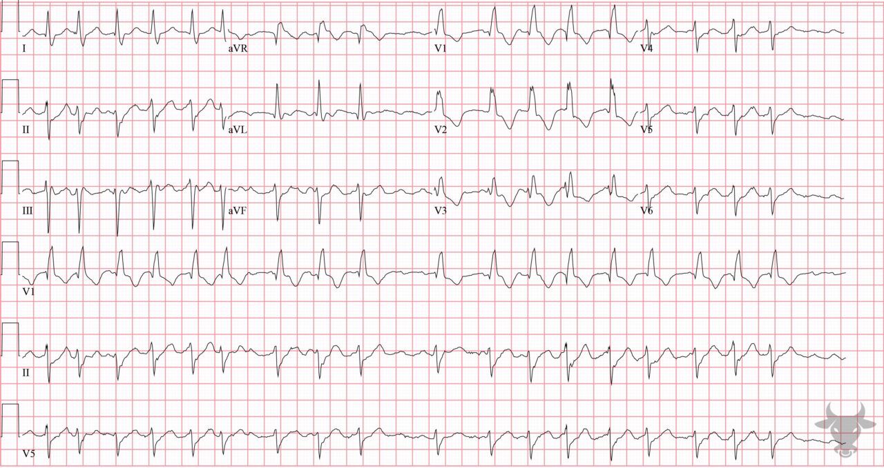 Right Bundle Branch Block | ECG Stampede