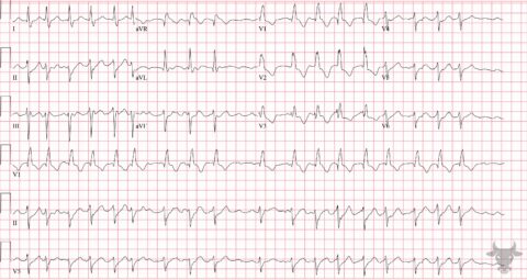 Right Bundle Branch Block | ECG Stampede