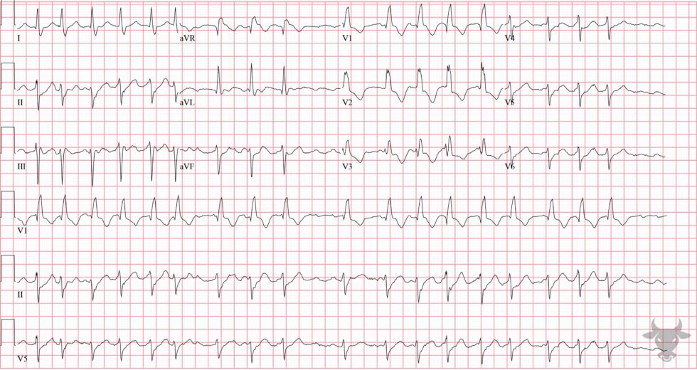 Atrial Fibrillation | ECG Stampede