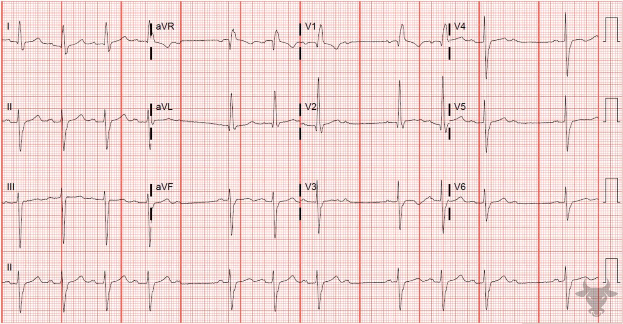 Second Degree Atrioventricular Block – Mobitz I | ECG Stampede