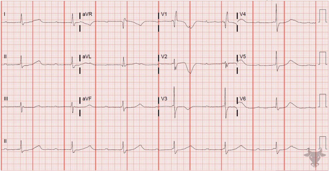 Third Degree Atrioventricular Block | ECG Stampede