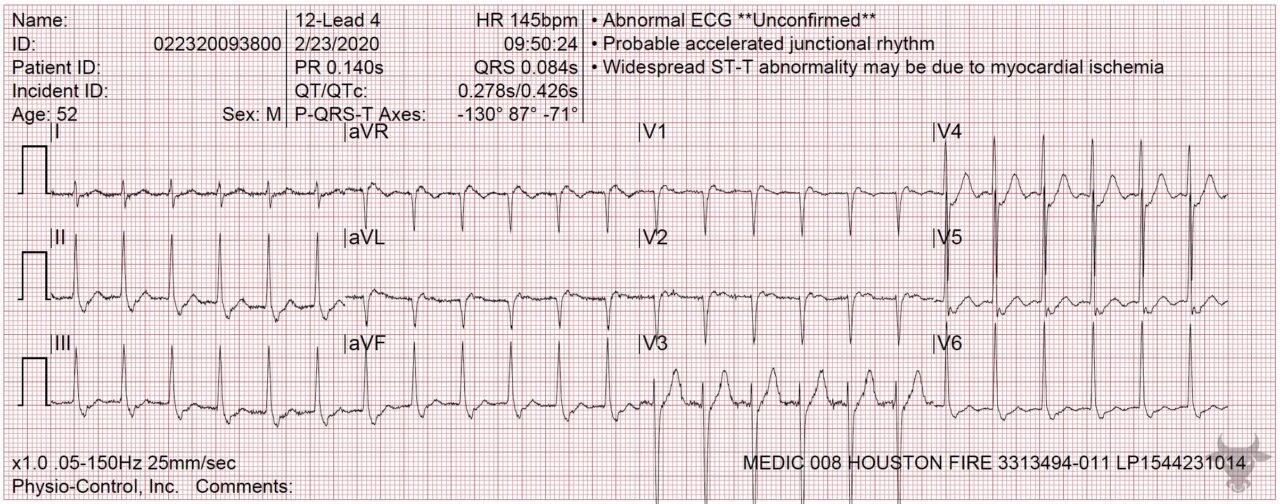 Supraventricular Tachycardia | ECG Stampede