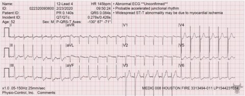 Atrioventricular Nodal Reentrant Tachycardia | ECG Stampede