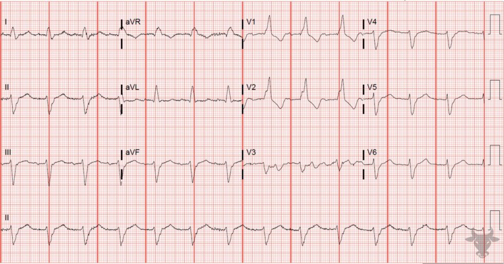 Right Bundle Branch Block | ECG Stampede
