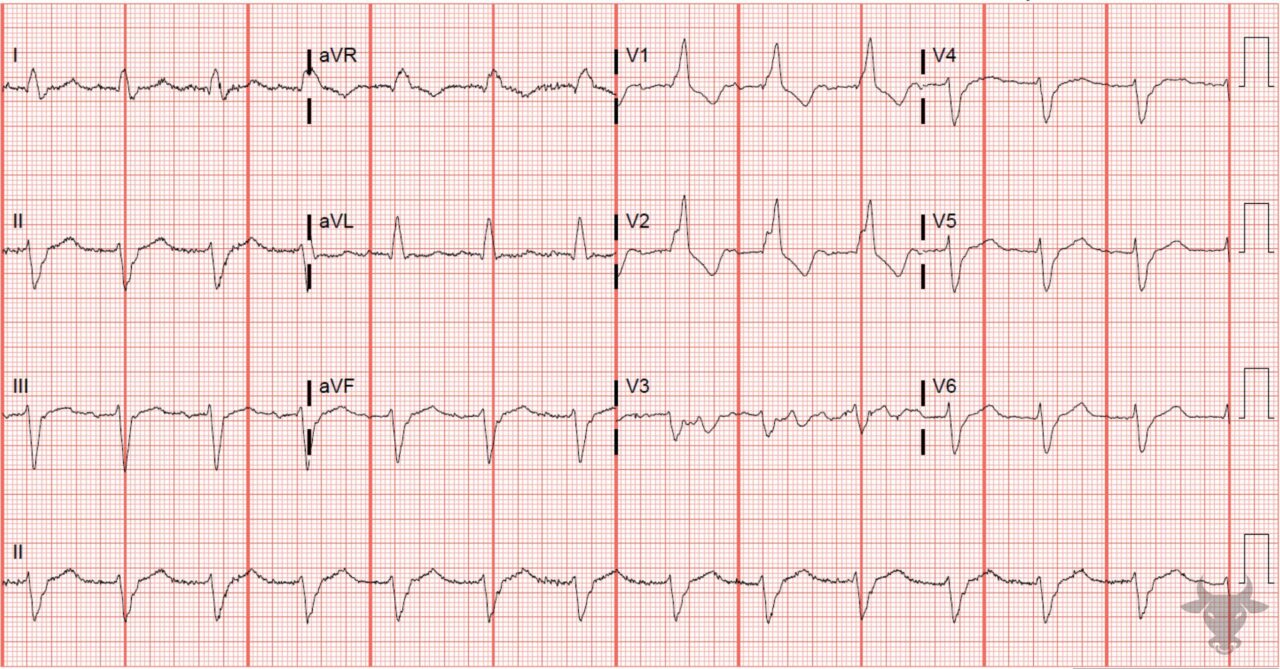 Left Anterior Fascicular Block | ECG Stampede