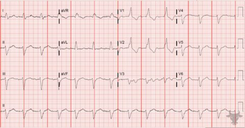 Left Anterior Fascicular Block | ECG Stampede