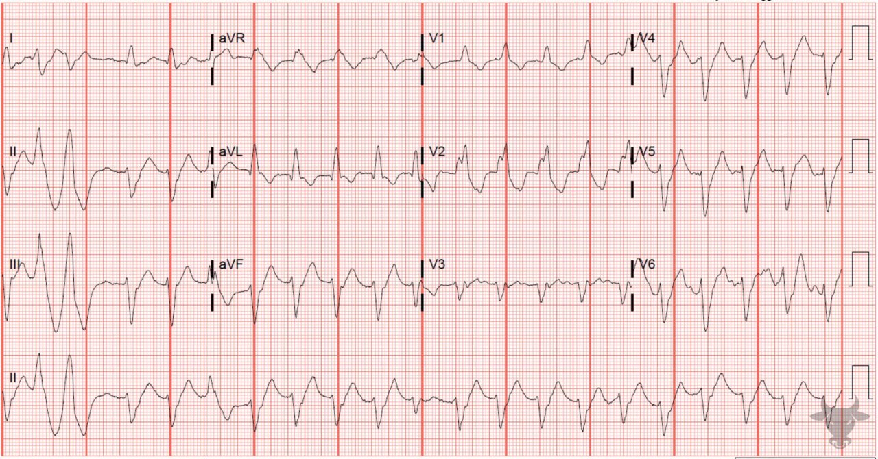 Right Bundle Branch Block | ECG Stampede