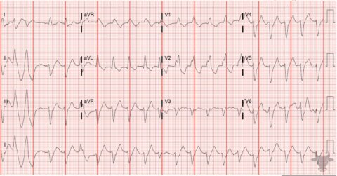 Trifascicular Block | ECG Stampede
