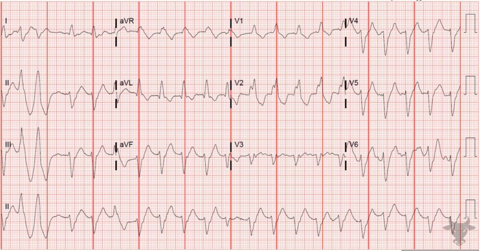 Right Bundle Branch Block | ECG Stampede