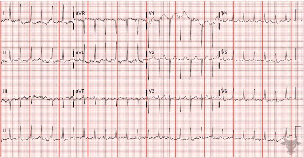Atrial Flutter | ECG Stampede