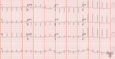 Lewis Lead | ECG Stampede