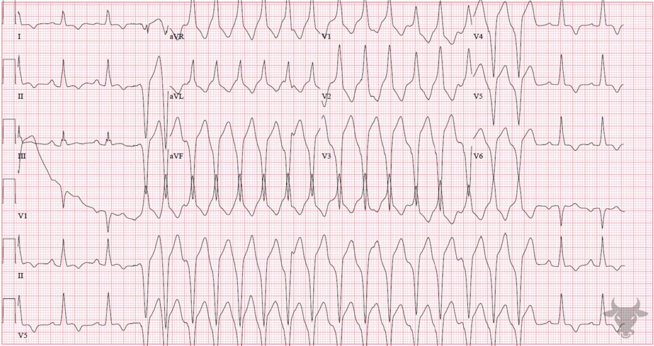 Hypertrophic Cardiomyopathy | ECG Stampede