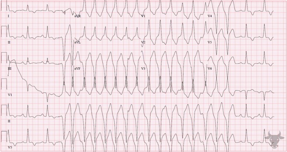 Hypertrophic Cardiomyopathy | ECG Stampede