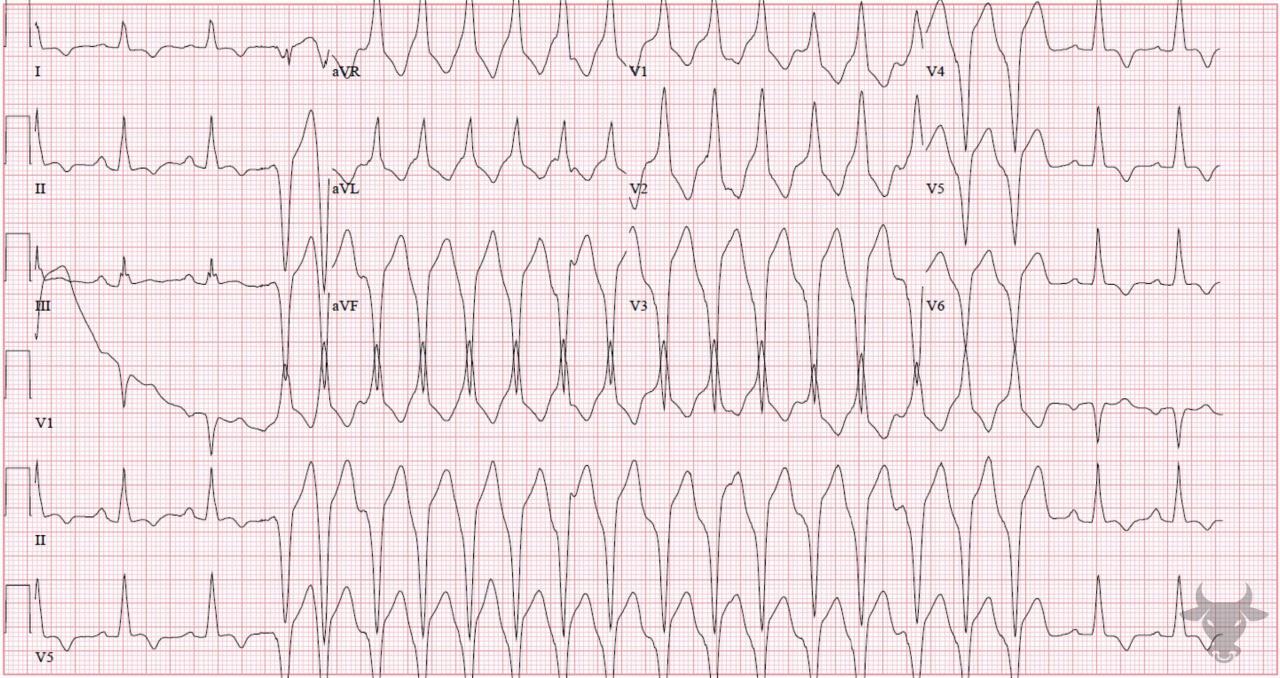 Ventricular Tachycardia | ECG Stampede