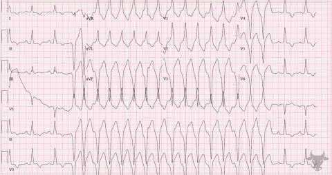 Ventricular Tachycardia | ECG Stampede