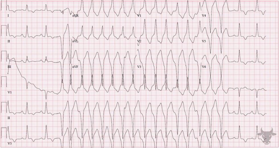 Ventricular Tachycardia | ECG Stampede