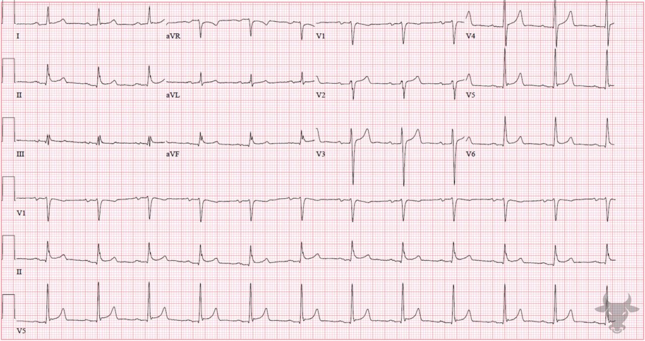 Acute Pericarditis | ECG Stampede