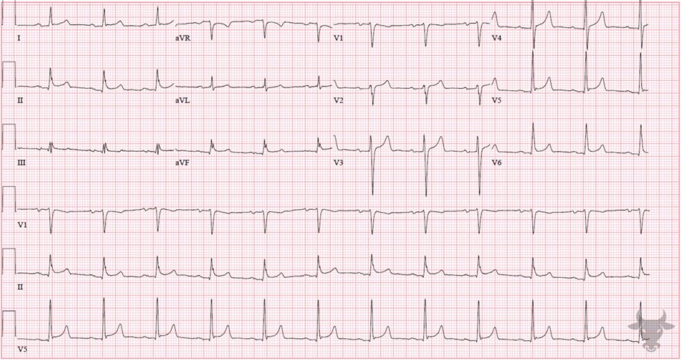 Acute Pericarditis | ECG Stampede