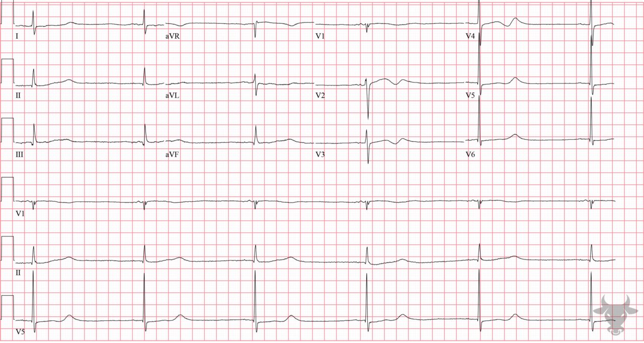 Sinus Node Dysfunction | ECG Stampede