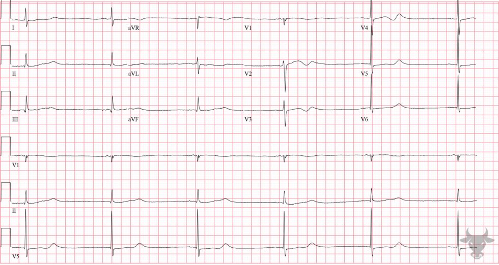 Sinus Node Dysfunction | ECG Stampede