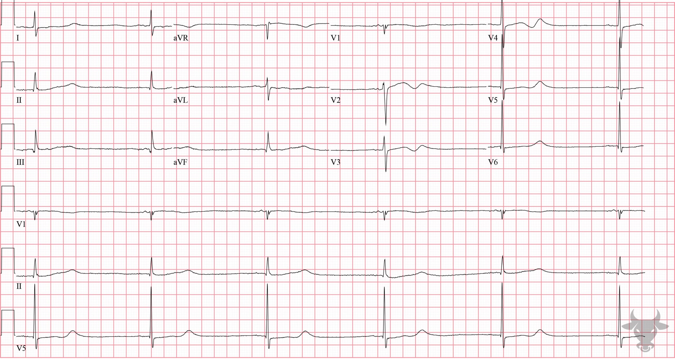 Sinus Node Dysfunction ECG Stampede