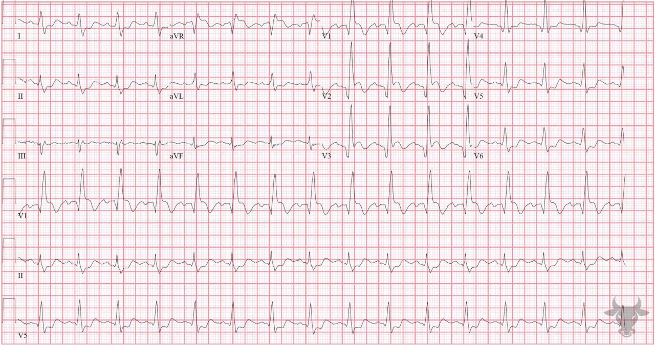 ST-elevation Myocardial Infarction | ECG Stampede