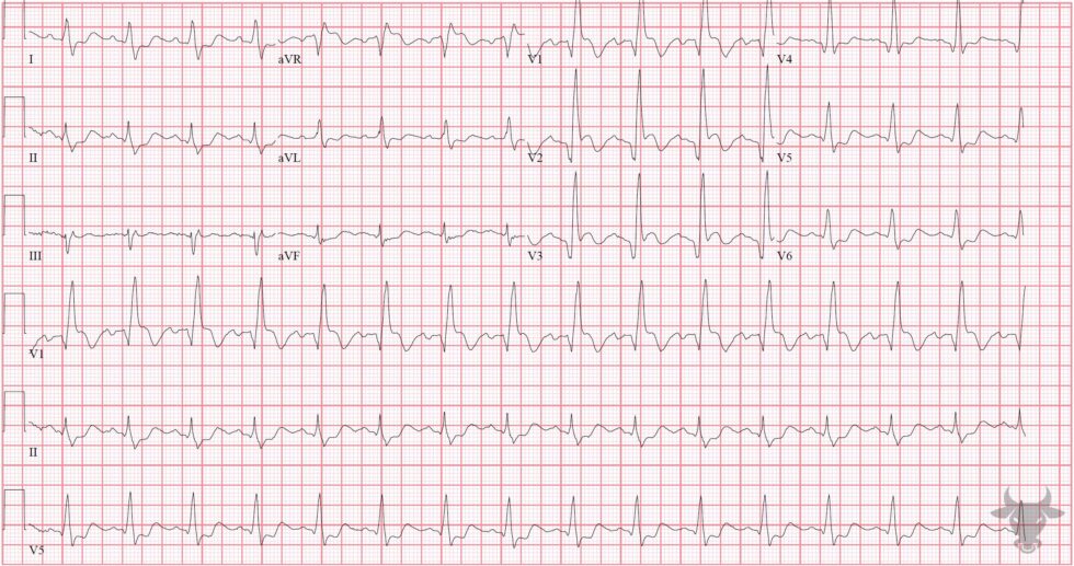 Right Bundle Branch Block | ECG Stampede