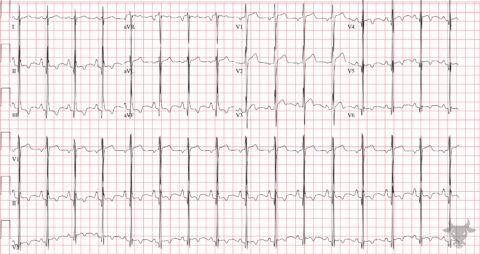Right Atrial Enlargement | ECG Stampede
