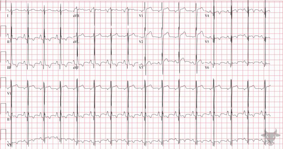 T-wave Inversions | ECG Stampede