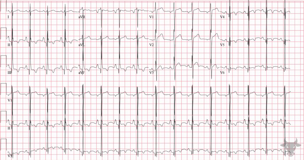 Left Ventricular Hypertrophy | ECG Stampede