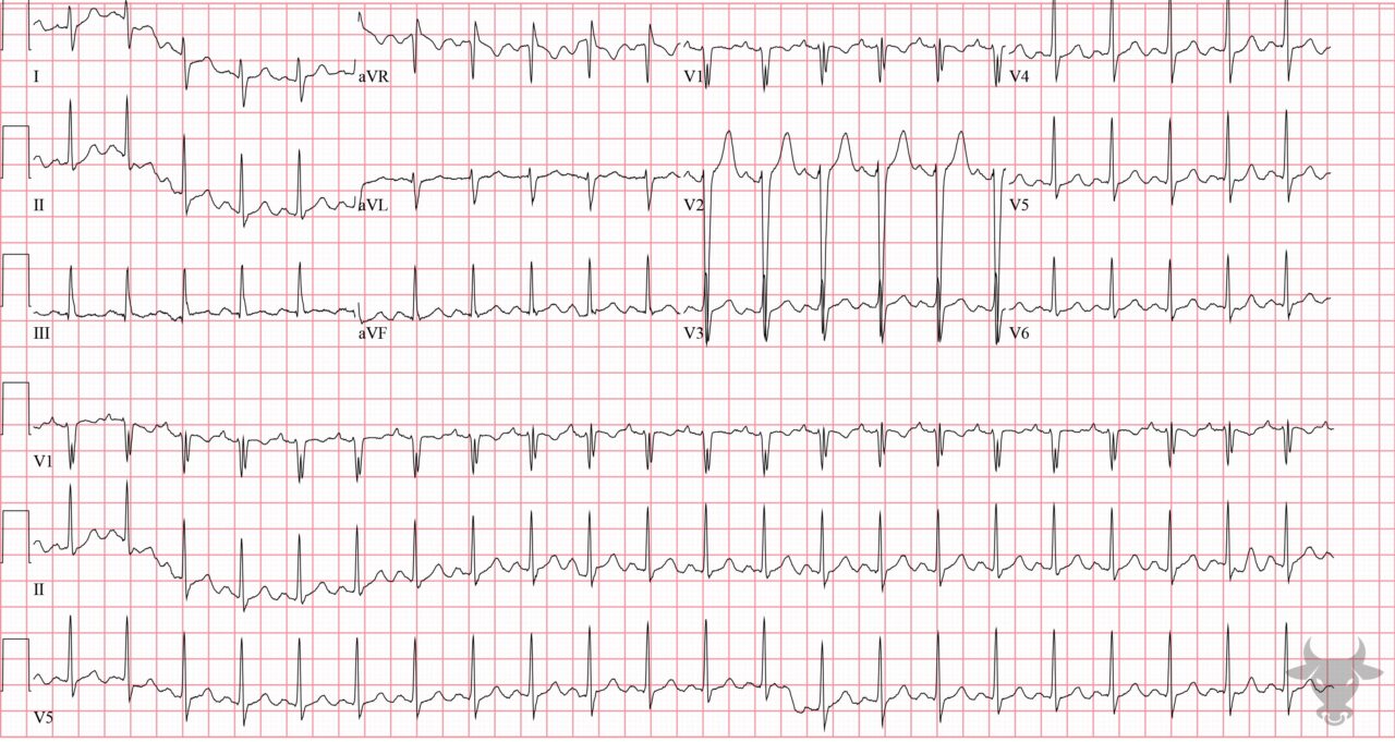 Sodium Channel Toxicity | ECG Stampede