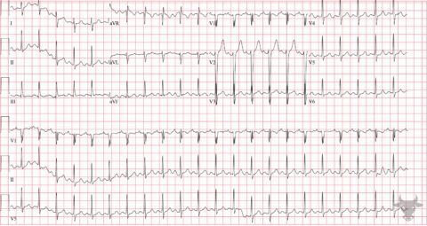 Sodium Channel Toxicity | ECG Stampede