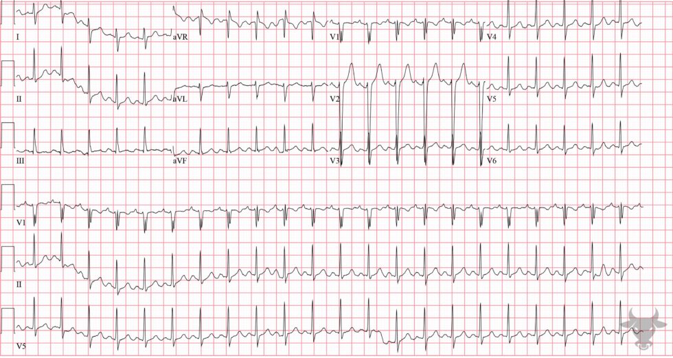 Sodium Channel Toxicity | ECG Stampede