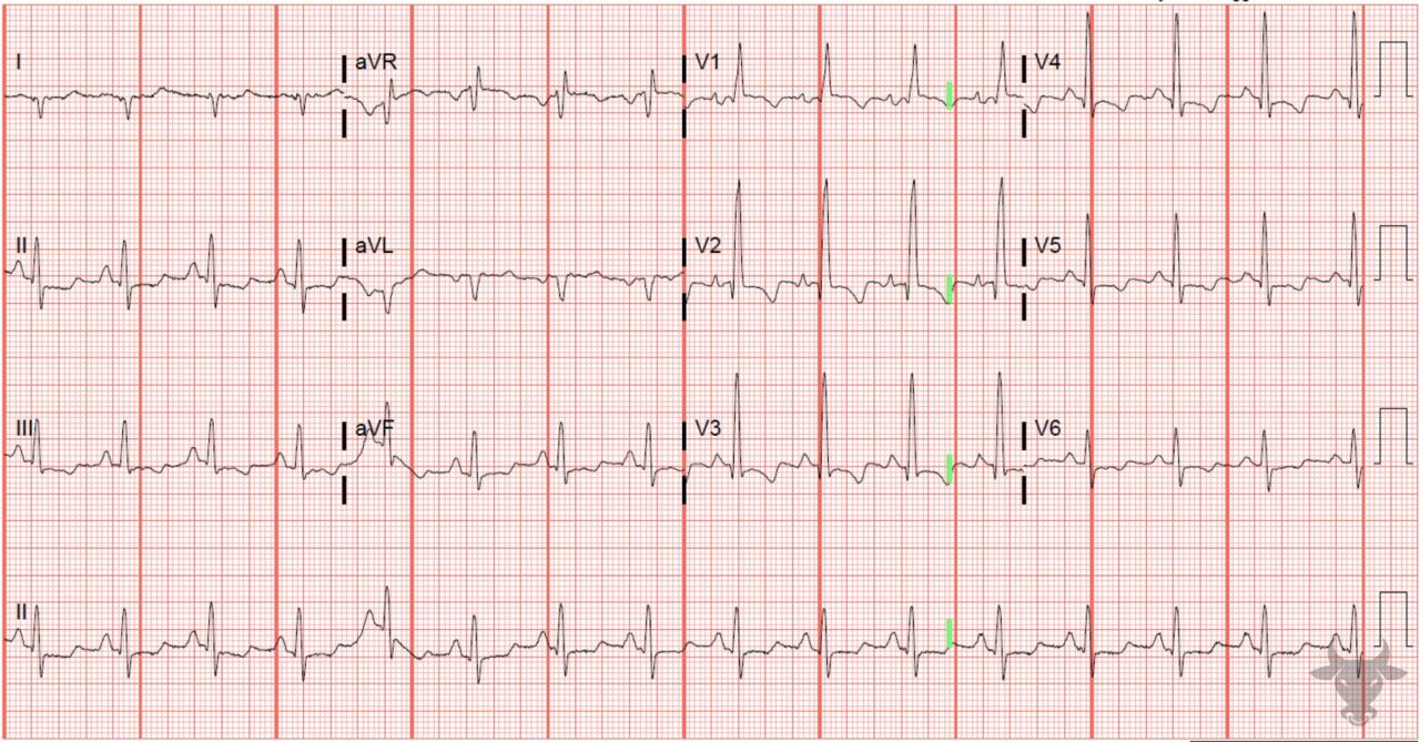 Right Atrial Enlargement | ECG Stampede