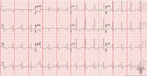 Right Atrial Enlargement | ECG Stampede