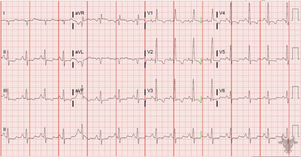 Right Atrial Enlargement | ECG Stampede