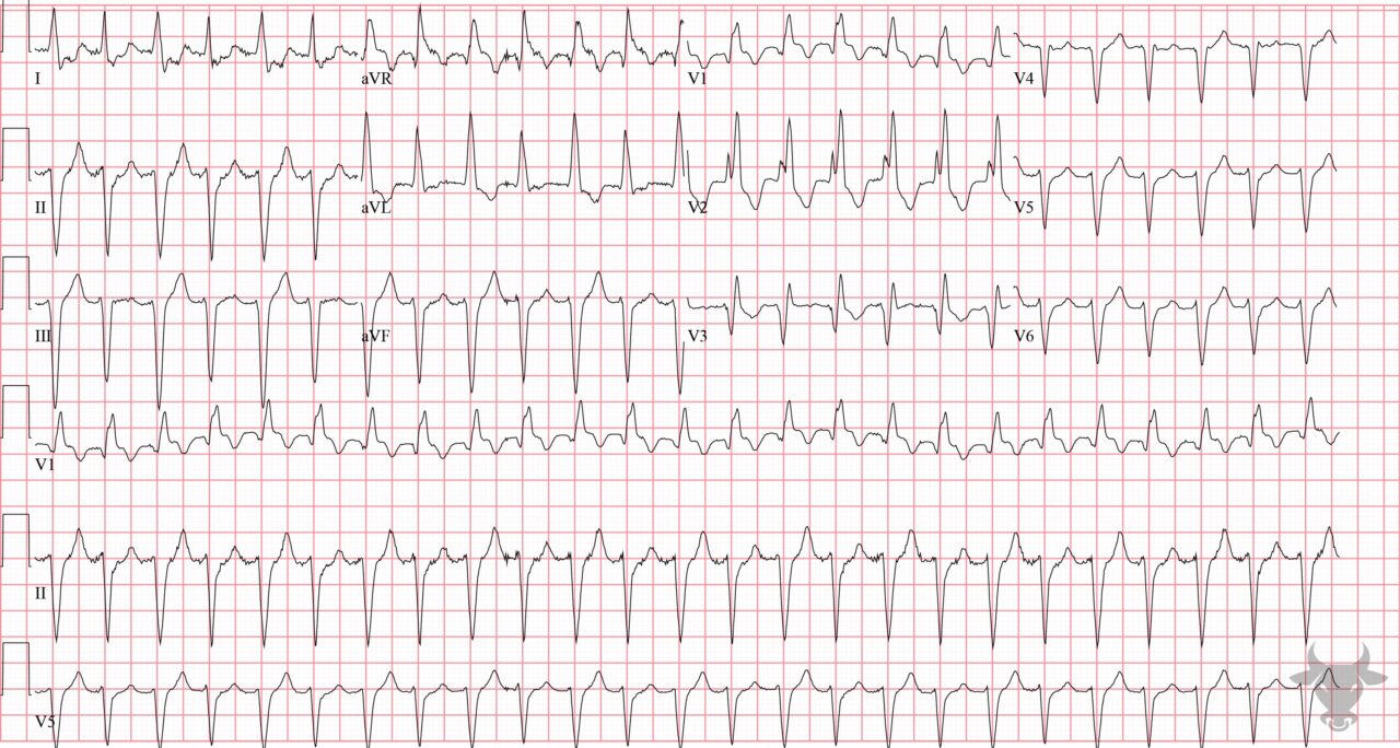 Supraventricular Tachycardia With Aberrancy Ecg Stampede