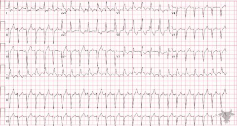 Supraventricular Tachycardia with Aberrancy | ECG Stampede