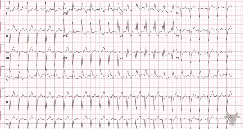 Bifascicular Block | ECG Stampede