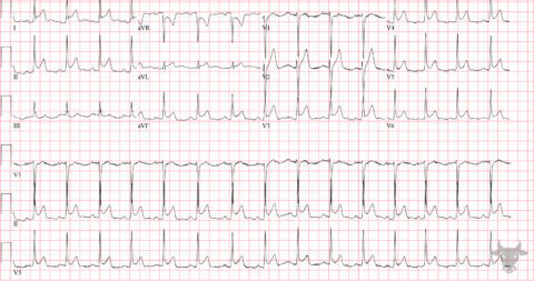 Acute Pericarditis | ECG Stampede